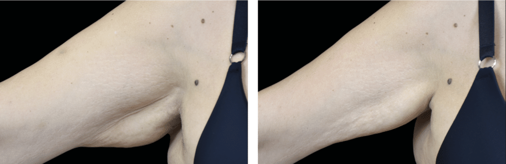 Emtone in NYC - Cellulite & Skin Tightening Treatment - Sobel Skin