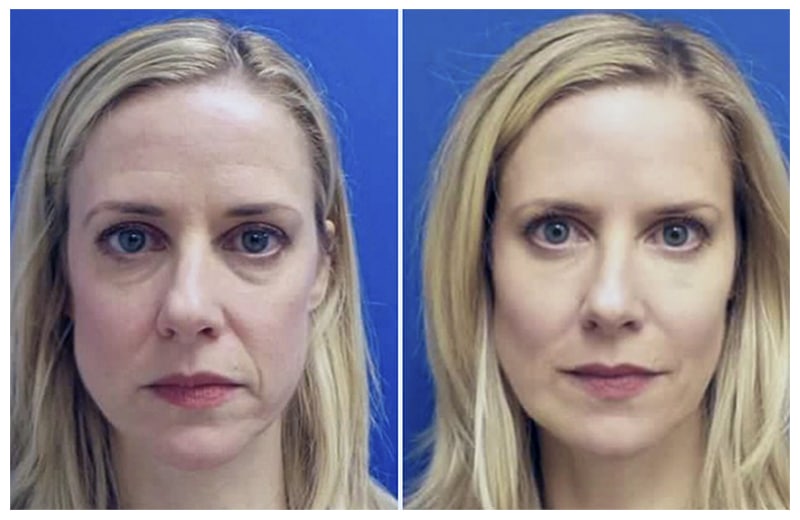 Before & After Photos of Restylane Injectable Treatments - Sobel Skin